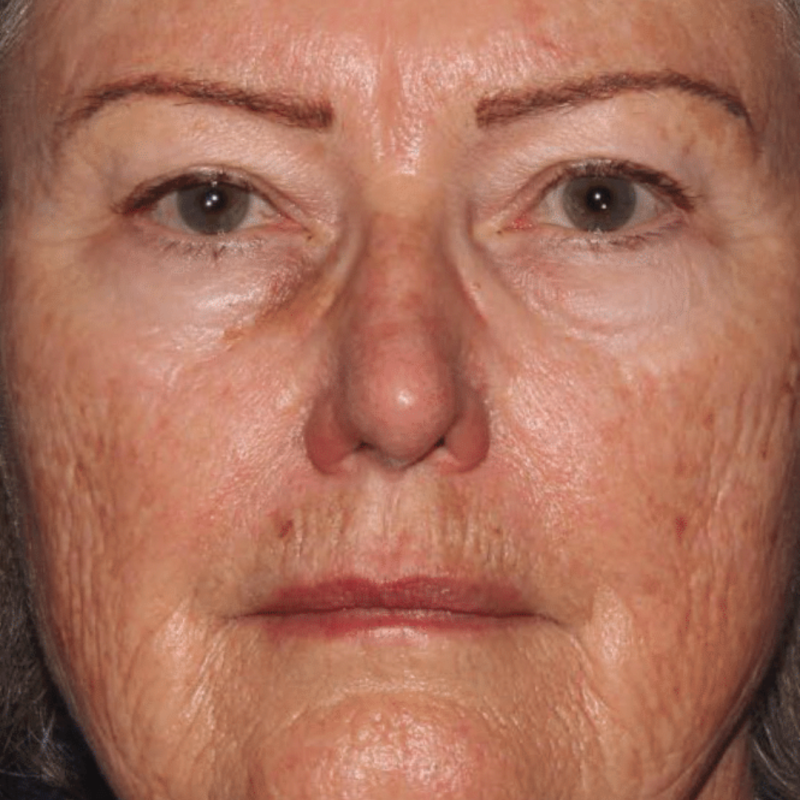 Deep Resurfacing Skin Laser | Array Aesthetics Belfast