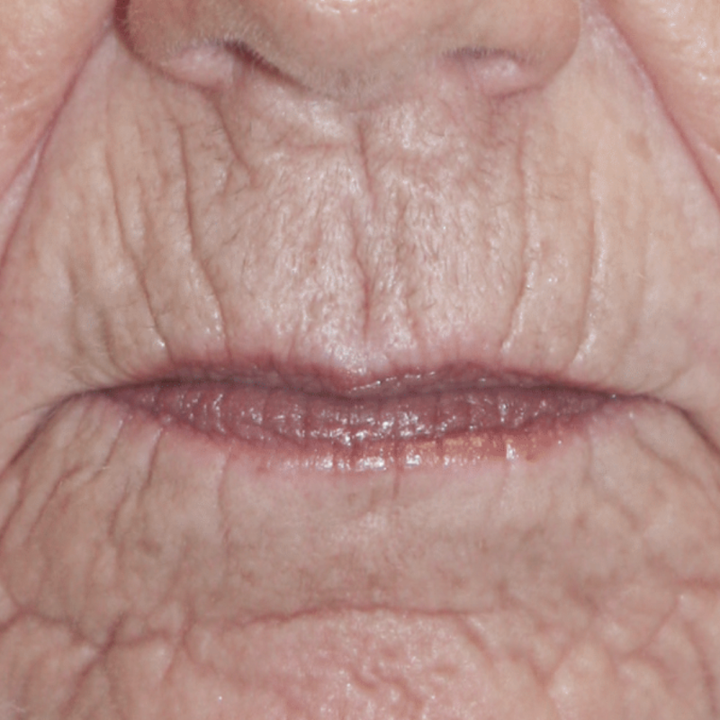 Deep Resurfacing Skin Laser | Array Aesthetics Belfast