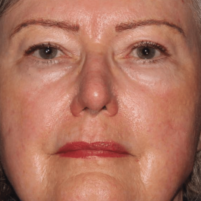 Deep Resurfacing Skin Laser | Array Aesthetics Belfast